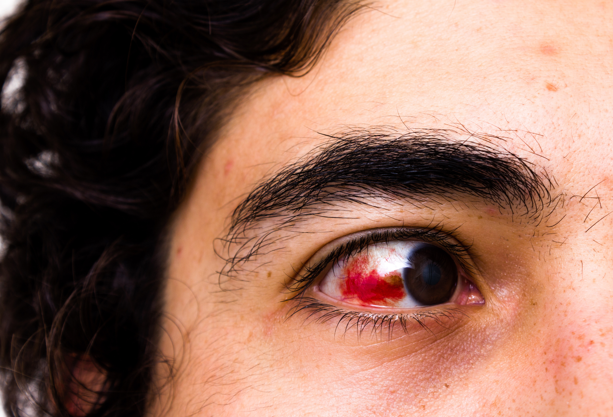 Common Types Of Eye Injuries Include